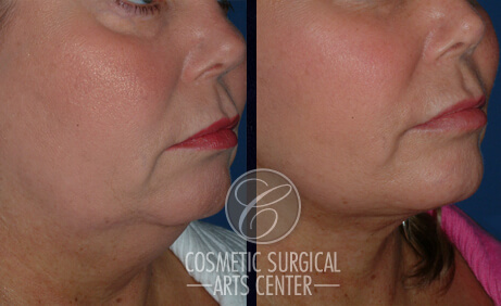 Top-rated Neck Lifts | Seattle & Bellevue Cosmetic Surgery
