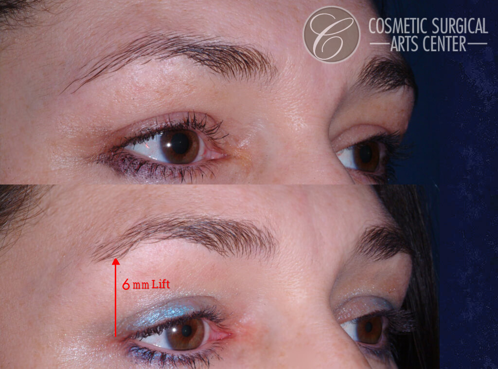 Ultherapy for the brow non-surgical facelift - Lynnwood, Mt Vernon WA ...